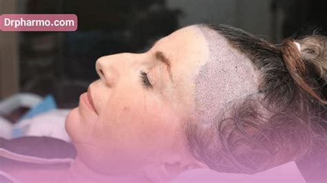 پیوند مو کاشت مو چیست و چگونه انجام می‌شود؟ معرفی روش ها