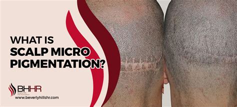 What Is Scalp Micro Pigmentation Beverly Hills Hair Restoration What Is Scalp Micro Pigmentation Beverly Hills Hair Restoration