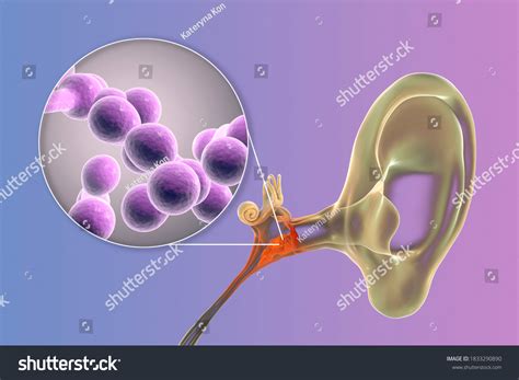 Otitis Media Supurativa Crónica Causada Por Ilustración De Stock