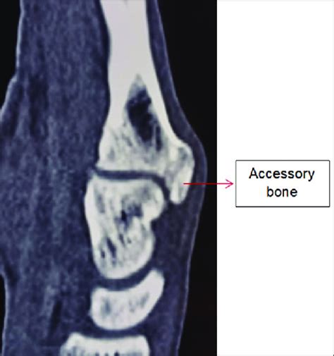Representative Sagittal Reconstructed Computed Tomography Image Showing Download Scientific