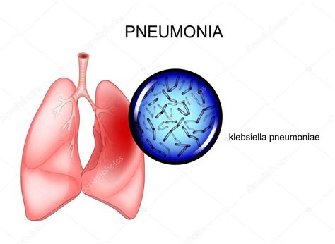 ilustración vectorial de neumonía agente causal klebsiella 2023
