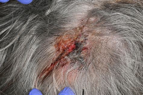 Scalp Laceration In Female Patient Stock Image C Science Photo Library