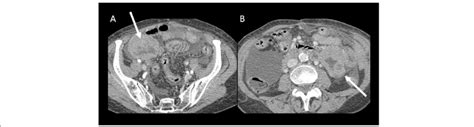 Ileal And Digiunal Gist Ct Shows Two Masses Arrow With An Extensive