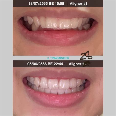 28 Trays Of Progress 5 More To Go R Invisalign