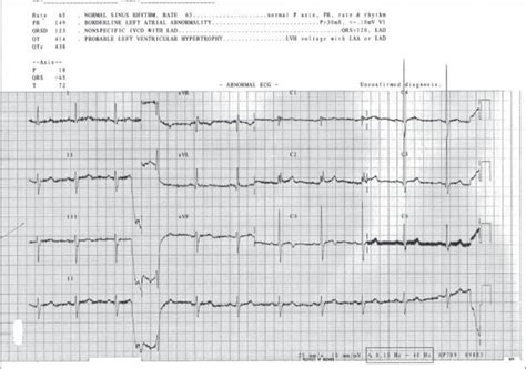 Preoperative Electrocardiography Demonstrating Sinus Rhythm Download Scientific Diagram