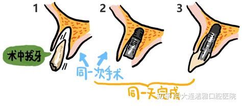 种植科普 即刻修复与即刻负重有什么区别 知乎