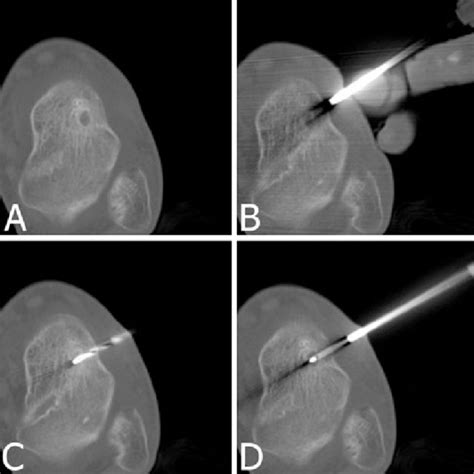 Pdf Radiofrequency Ablation Of Osteoid Osteoma In Atypical Locations A Case Series