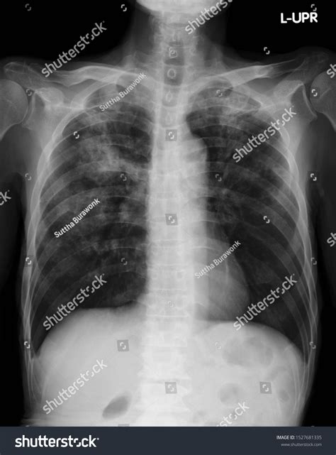 Chest Xray Image Showing Lung Infection Foto De Stock 1527681335