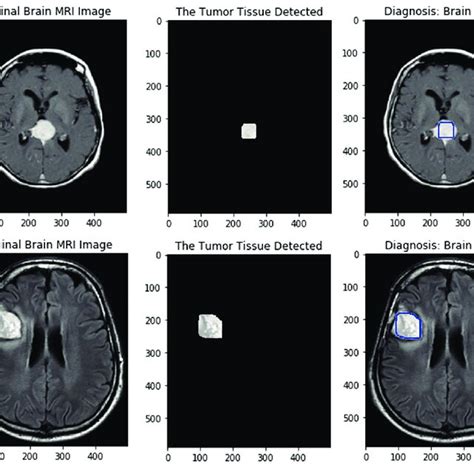 Detection Of The Tumor By The Model Download Scientific Diagram