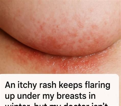 An Itchy Rash Keeps Flaring Up Under My Breasts In Winter—what Can I Do
