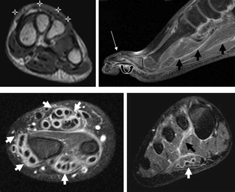 Sat0365 Musculoskeletal Us And Mri Findings In Juvenile Scleroderma Annals Of The Rheumatic