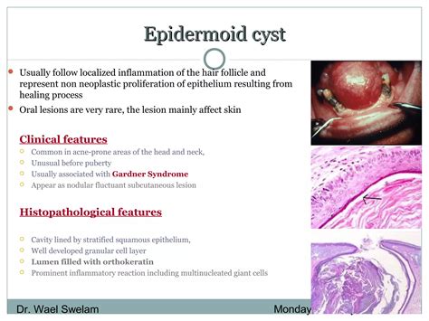 Pseudo Cyst Pps