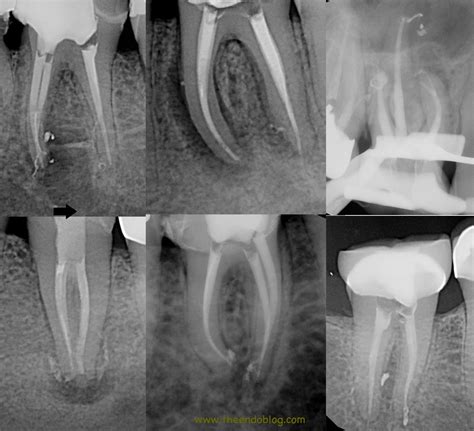 The Endo Blog The Buzz About Endodontic Irrigation