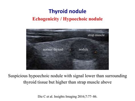 Ultrasound Of Thyroid Nodules Ppt