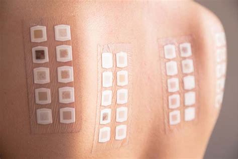 Patch Testing For Ibs Philadelphia Allergists Chestnut Hill Allergy