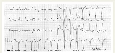 For Atrial Pacing The Electrocardiography Showed Vvi Pacing