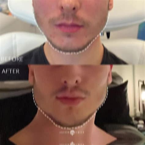 Male Facial Scultping Video Realself