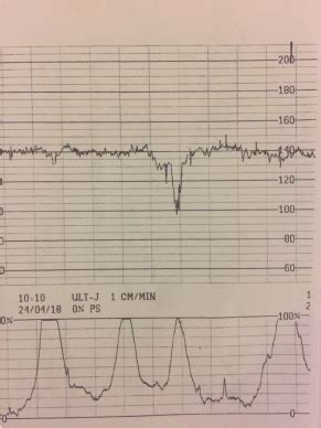 The Value Of A Single Isolated CTG Trace Deceleration