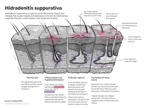 Pathological Illustrationhidradenitis Suppurativa — Emily Huang