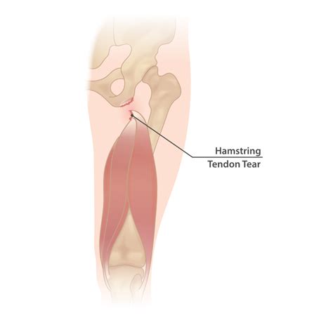 Complete Proximal Hamstring Avulsion And Surgical Reattachment Of Hamstring Tendons To Bone By
