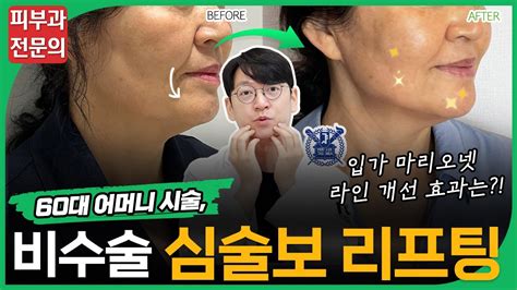 심술보 심부볼 마리오네트 주름 등 비수술로 없애는 방법📌 50대60대 리프팅 추천 전후사진 등 Youtube