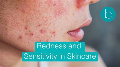A Comprehensive Guide To Redness And Sensitivity In Skincare London