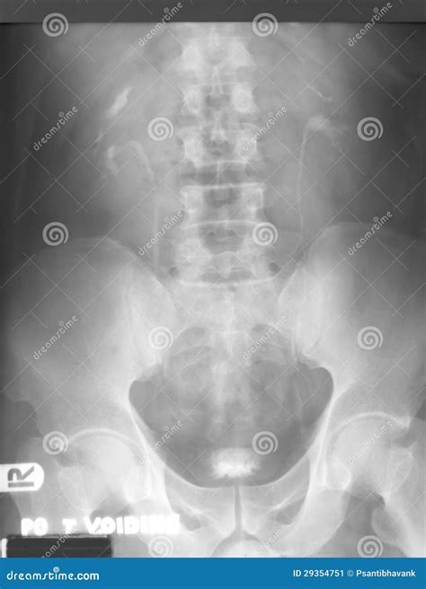 Intravenous Pyelography Ivp 10 Minutes After Urographin Injection Film Of A 41 Years Old Man