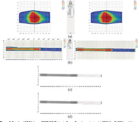 Figure 3 From A Patient Specific Qa Comparison Between 2d And 3d Diode Arrays For Single Lesion