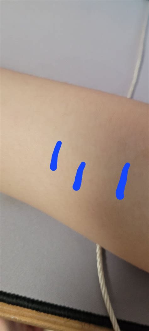 몸에 작은 물집 지식in