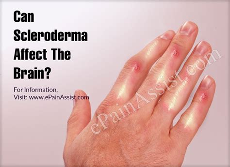 Can Scleroderma Affect The Brain
