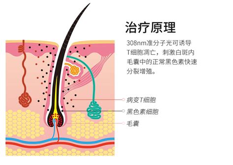 308紫外线光疗仪治疗白癜风的原理是什么？ 知乎