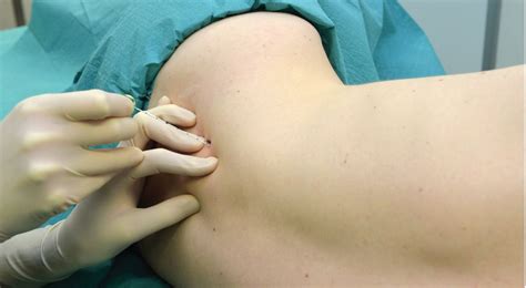 Lumbar Plexus Block Landmark Technique