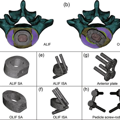 Finite Element Model Of L4 L5 With Associated Soft Tissues Download Scientific Diagram