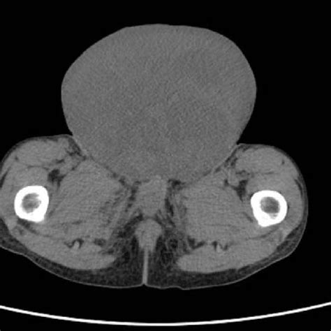 Axial Enhanced Ct Scan Of The Pelvis Showing A Heterogeneously Download Scientific Diagram
