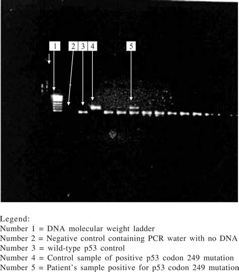 Detection Of P53 Codon 249 Mutation In Nigerian Patients With