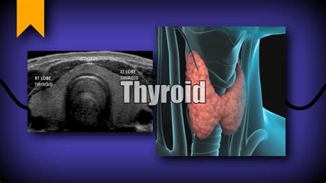 Thyroid Ultrasound Sonographic Tendencies