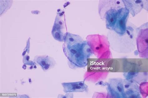 칸디다증 곰팡이 감염의 현미경으로 자궁경부 세포진 슬라이드 세포학 및 병리학자에 의한 진단 산부인과 보고서 및 진단 의료 개념입니다 0명에 대한 스톡 사진 및 기타 이미지