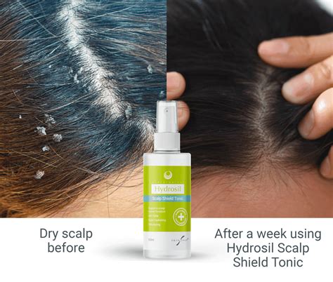 Solutions For Dry Scalp And Scalp Eczema