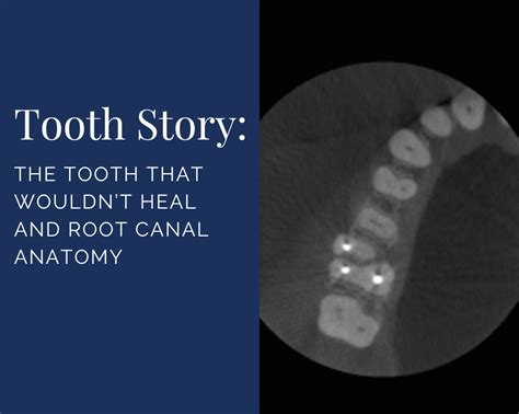 Horizontal Root Fracture Diagnosis And Treatment Sonia Chopra