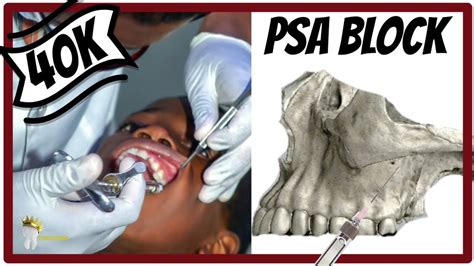 Posterior Superior Alveolar Injection Posterior Superior Alveolar