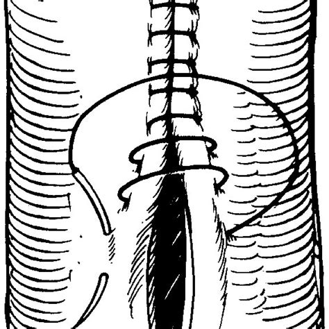 Continuous Lembert Suture Pattern Suture Placement Is Well Away From Download Scientific