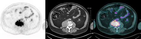 Hypermetabolic Lytic Lesion Of L3 Contiguously Invading Adjacent Soft Download Scientific