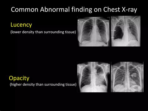 Chest X Ray Interpretation PDF
