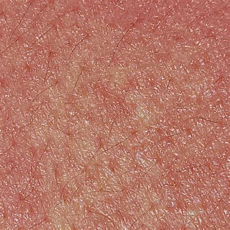 성인 땀띠 원인과 땀띠 연고 알아보기 네이버 블로그