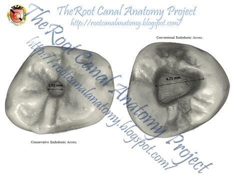 The Root Canal Anatomy Project Conservative Endodontic Access Maxillary Molar