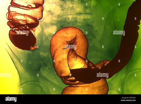 Healthy Appendix Coloured Double Contrast Barium Enema X Ray The Appendix Orange Is The