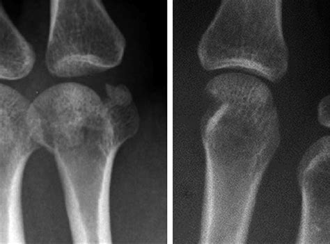 Metacarpal Fractures Hand Orthobullets