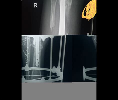 Кости голени Портал радиологов