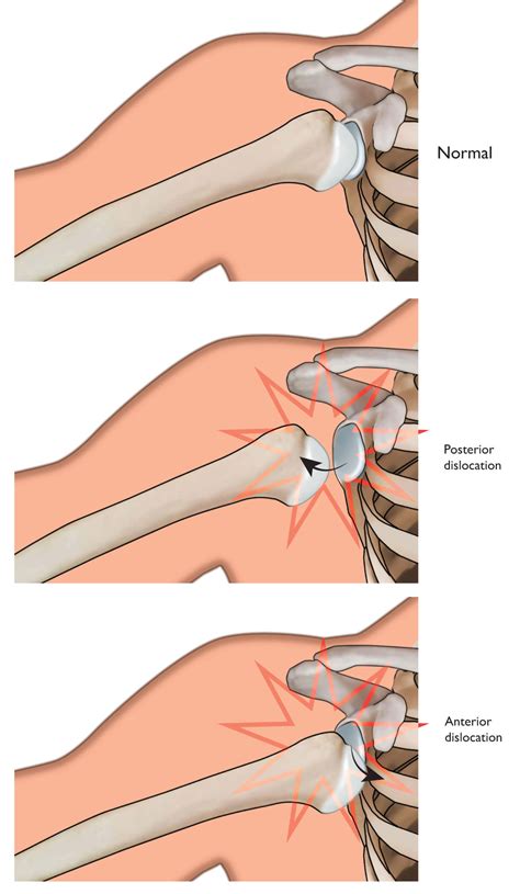 Anterior Shoulder Dislocation Msk Something About Radiology Just
