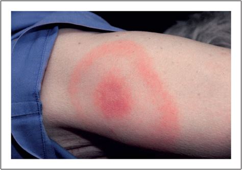 Lyme Carditis An Infectious Cause Of Atrioventricular Block A Case